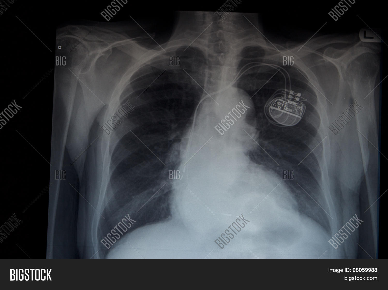 Chest Xray Pacemaker Image & Photo (Free Trial) | Bigstock