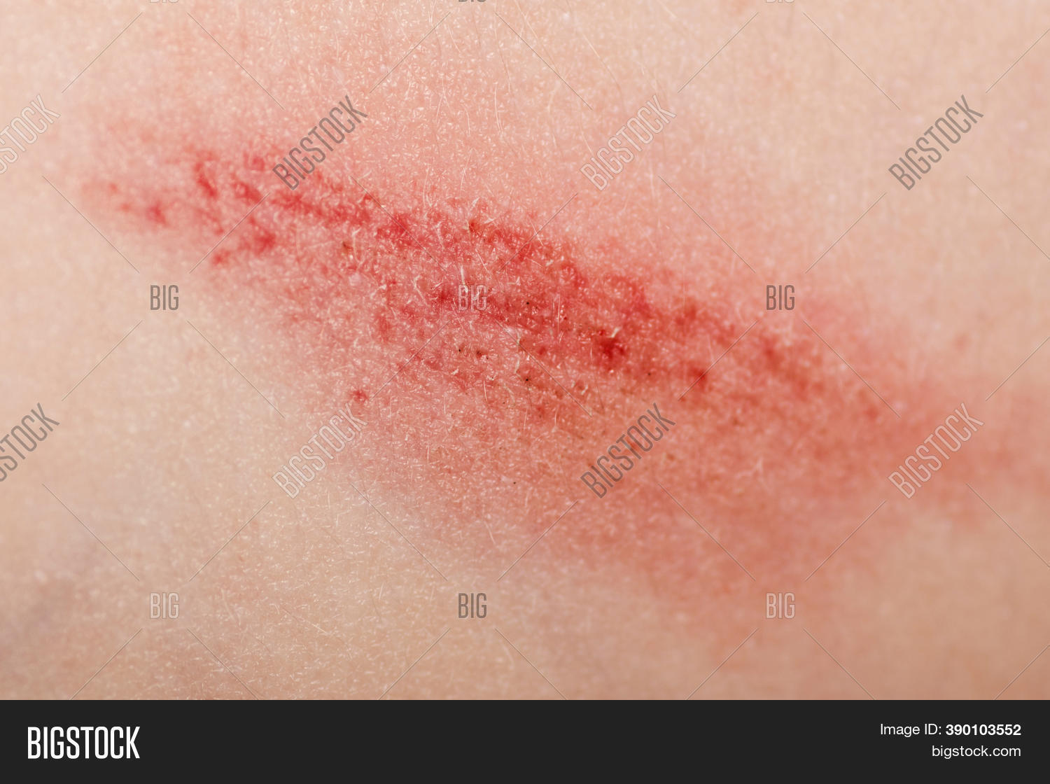 Wound On Human Body. Image & Photo (Free Trial) | Bigstock