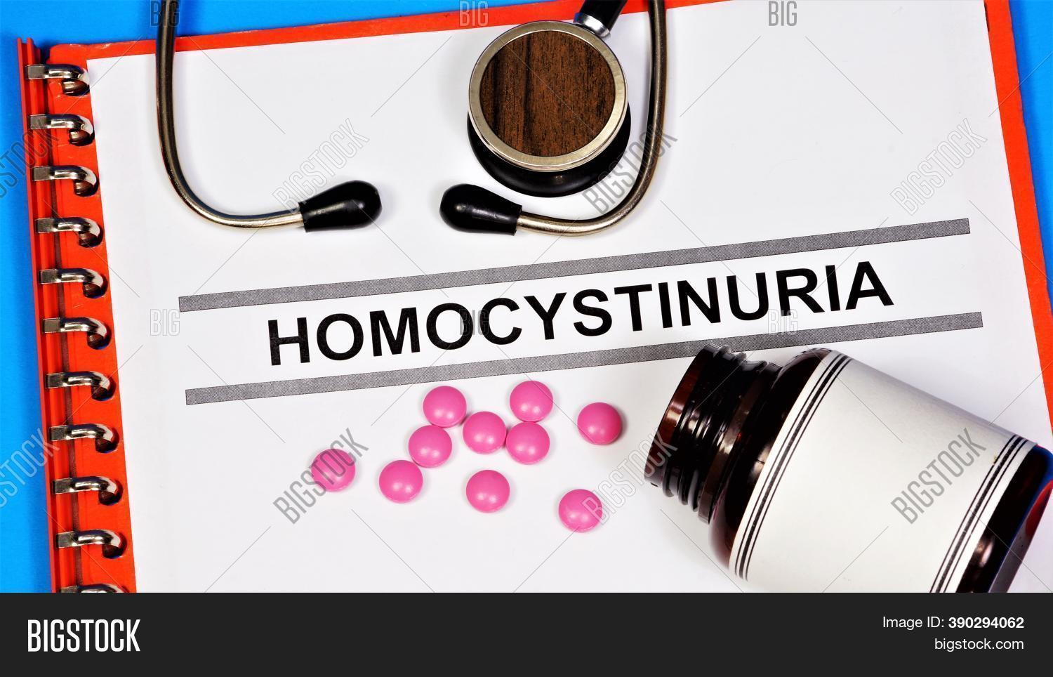 Homocystinuria Image & Photo (Free Trial) | Bigstock