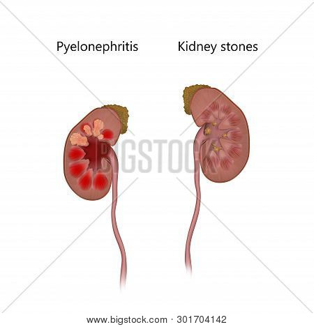 Pyelonephritis Vector & Photo (Free Trial) | Bigstock