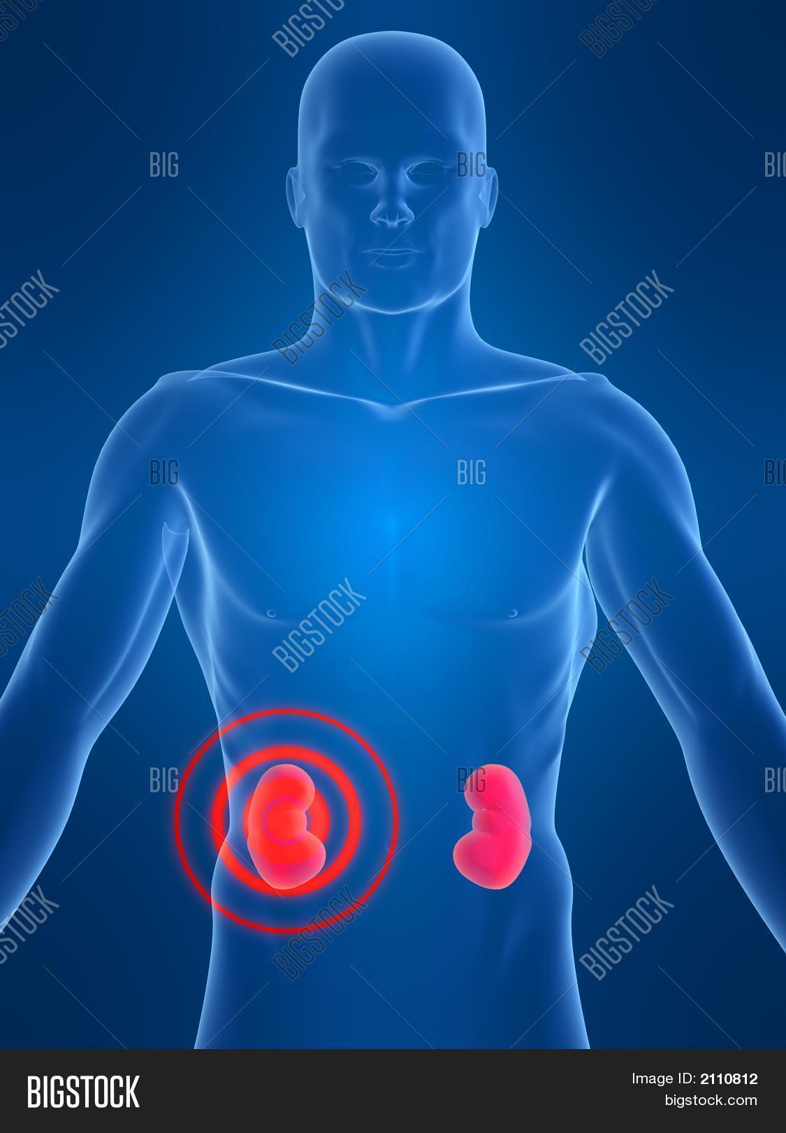 Kidney Inflammation Image & Photo (Free Trial) | Bigstock