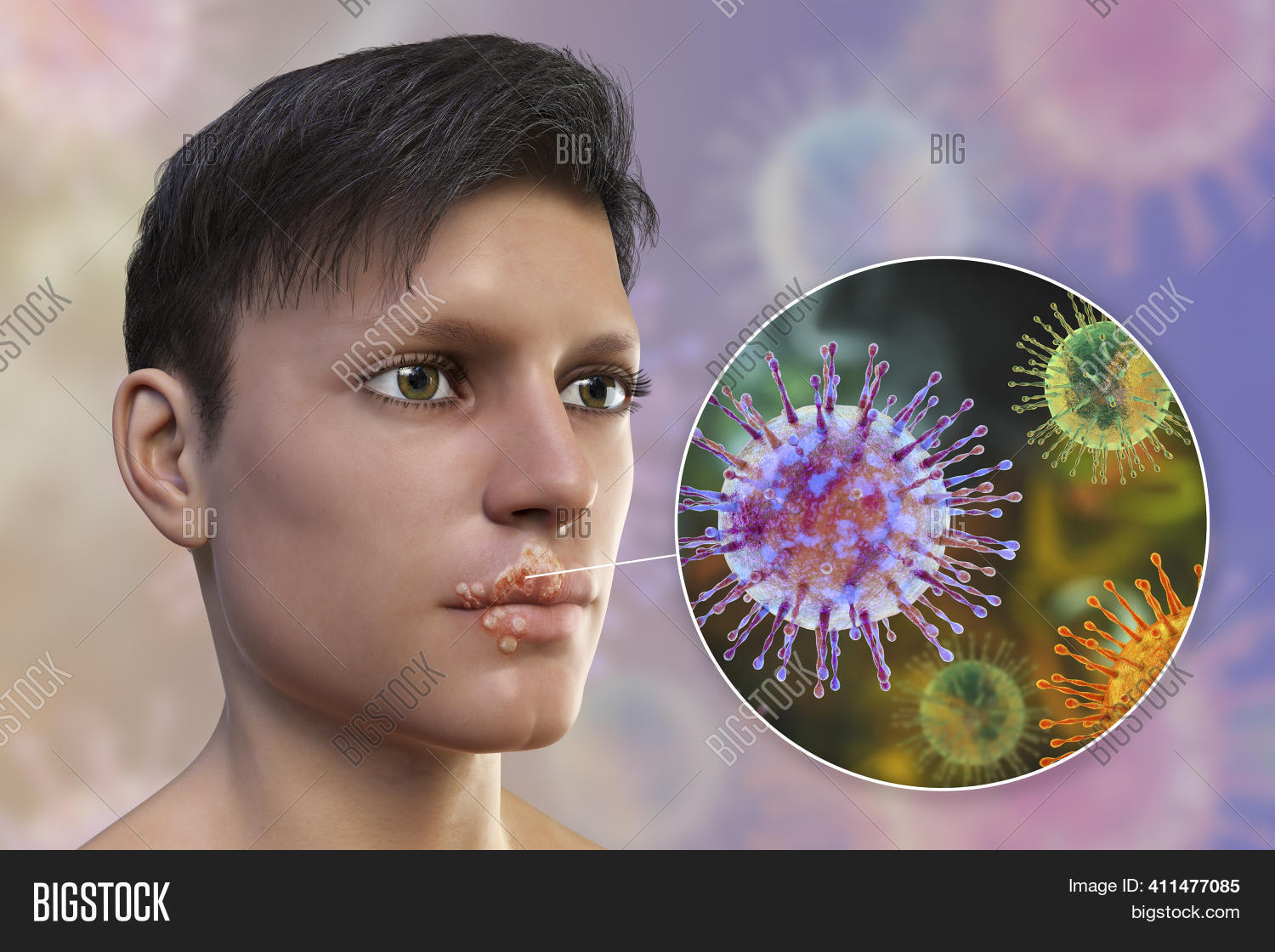 Herpes Labialis, Known Image & Photo (Free Trial) | Bigstock
