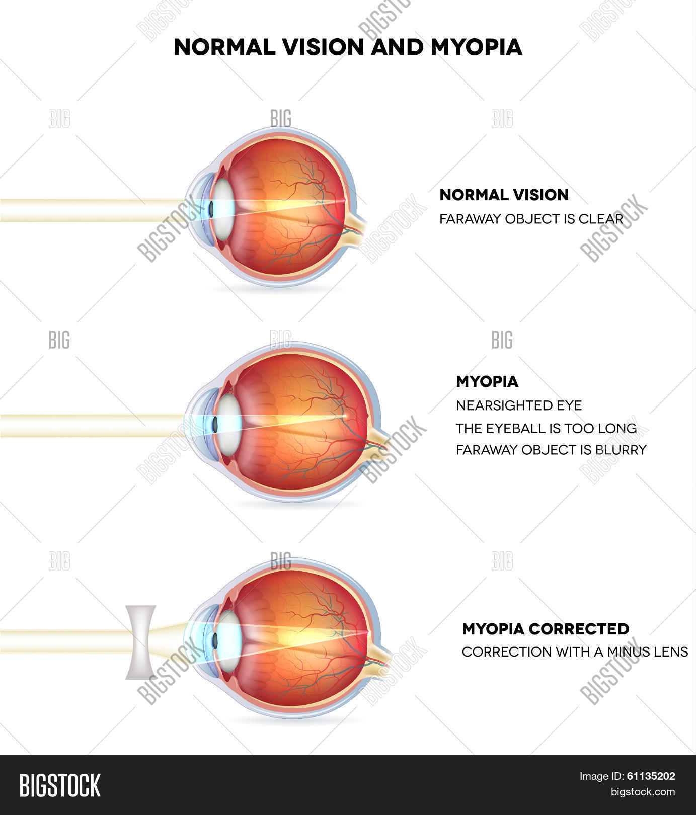 Myopia Normal Vision Vector & Photo (Free Trial) | Bigstock