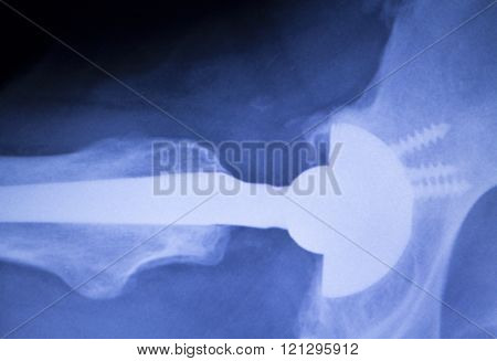 Hip Replacement Xray Image & Photo (Free Trial) | Bigstock