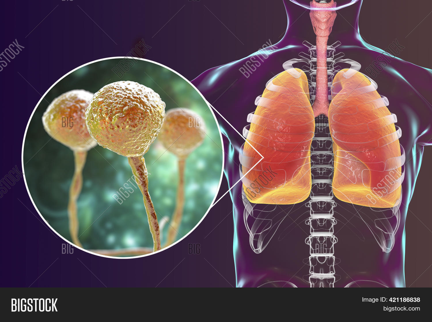 Lung Mucormycosis, Image & Photo (Free Trial) | Bigstock