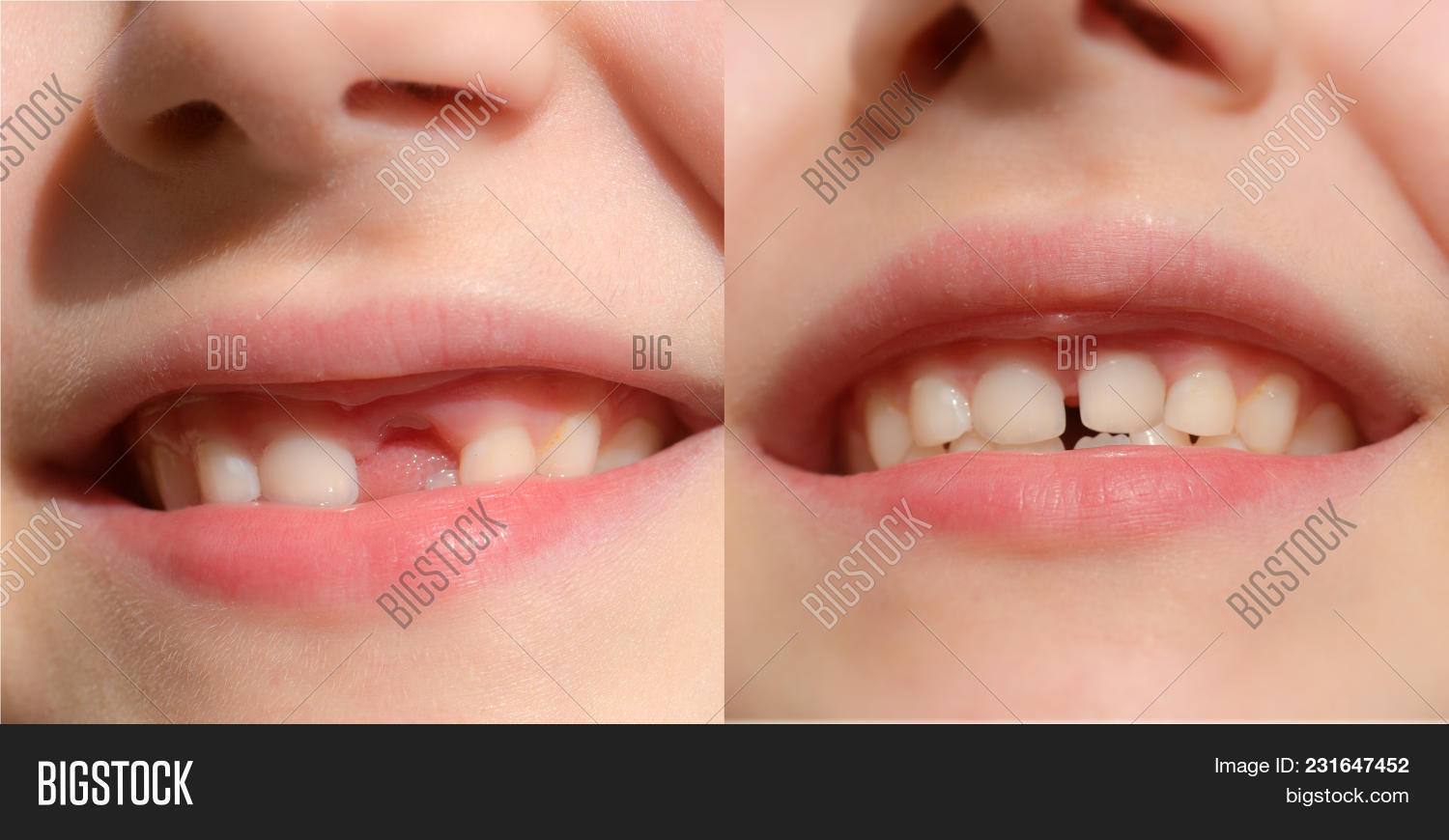 Loss Baby Tooth. Close Image & Photo (Free Trial) | Bigstock