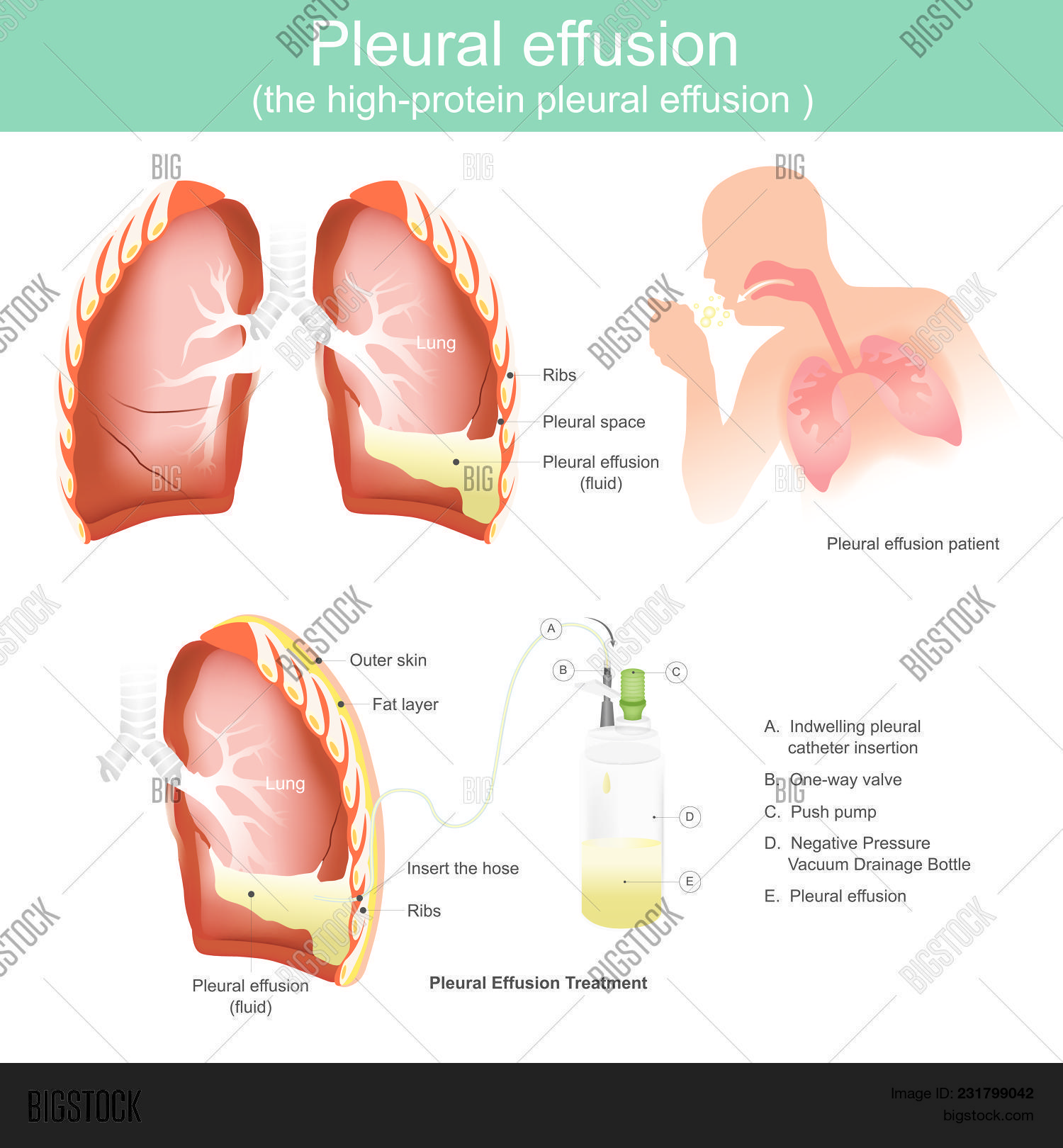 Pleural Effusion Vector & Photo (Free Trial) | Bigstock