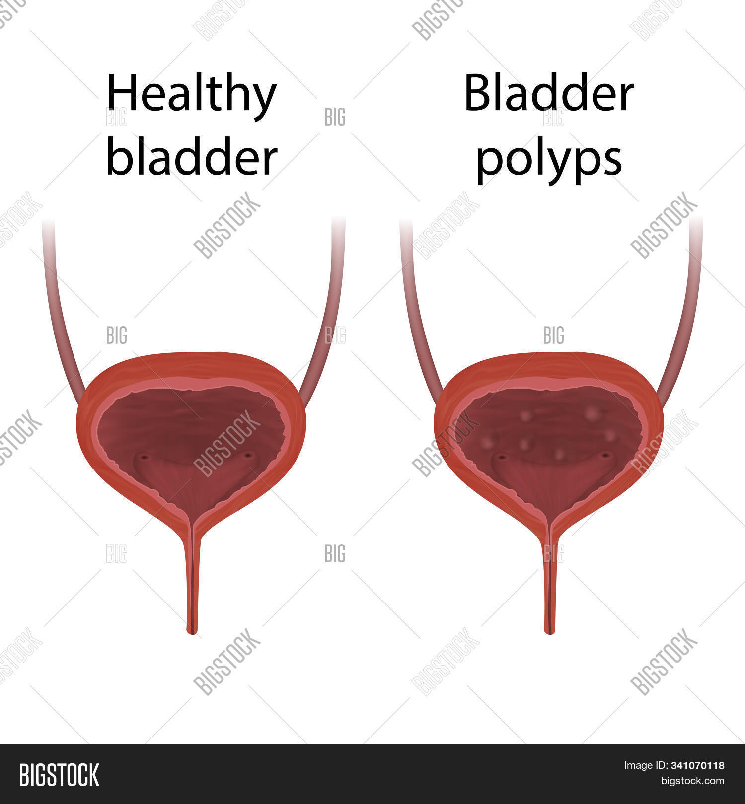 Bladder Polyps Healthy Image & Photo (Free Trial) | Bigstock