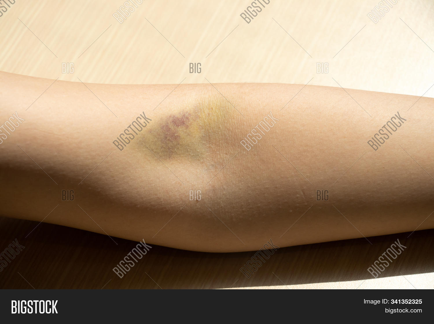 Bruise Injury On Image & Photo (Free Trial) | Bigstock