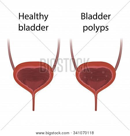 Bladder Polyps Healthy Image & Photo (Free Trial) | Bigstock