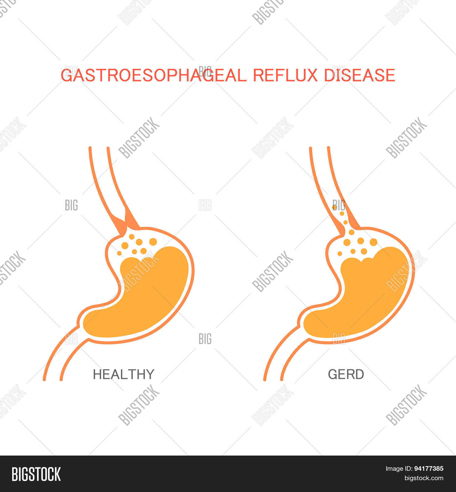 Stomach Reflux Vector & Photo (Free Trial) | Bigstock