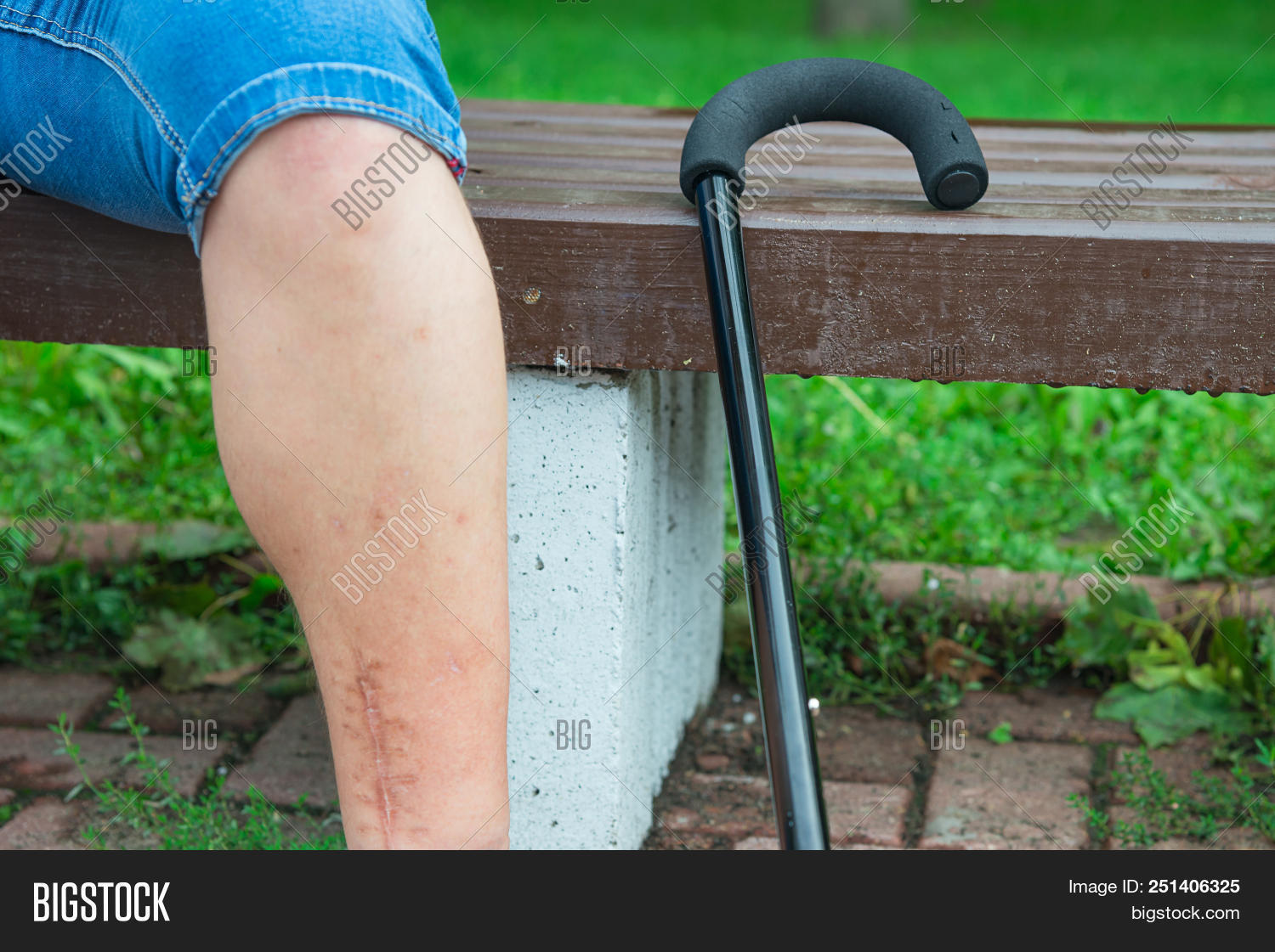 Scared Leg Disabled Image & Photo (Free Trial) | Bigstock
