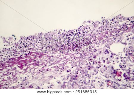 Bacterial Dysentery, Image & Photo (Free Trial) | Bigstock