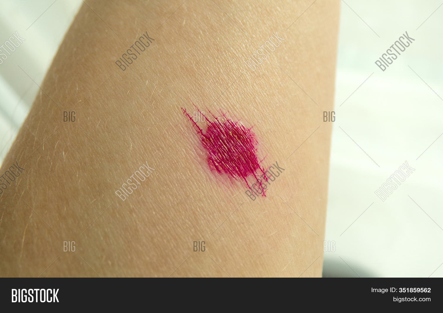 Wound On Skin Hand Image & Photo (Free Trial) | Bigstock