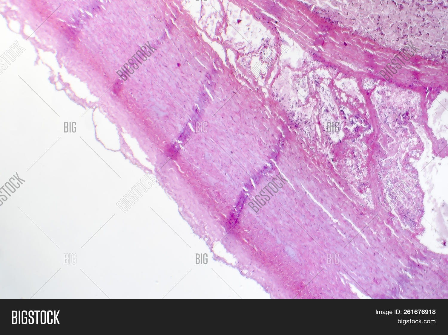 Fibrinoid Necrosis Image & Photo (Free Trial) | Bigstock