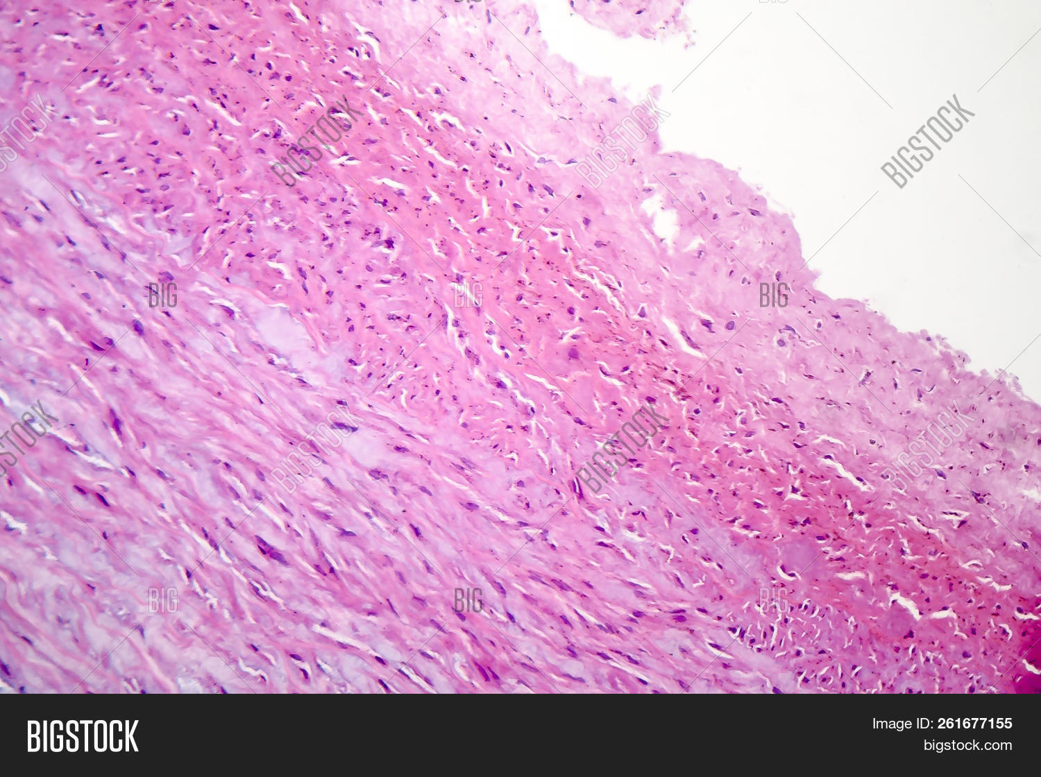 Fibrinoid Necrosis Image & Photo (Free Trial) | Bigstock