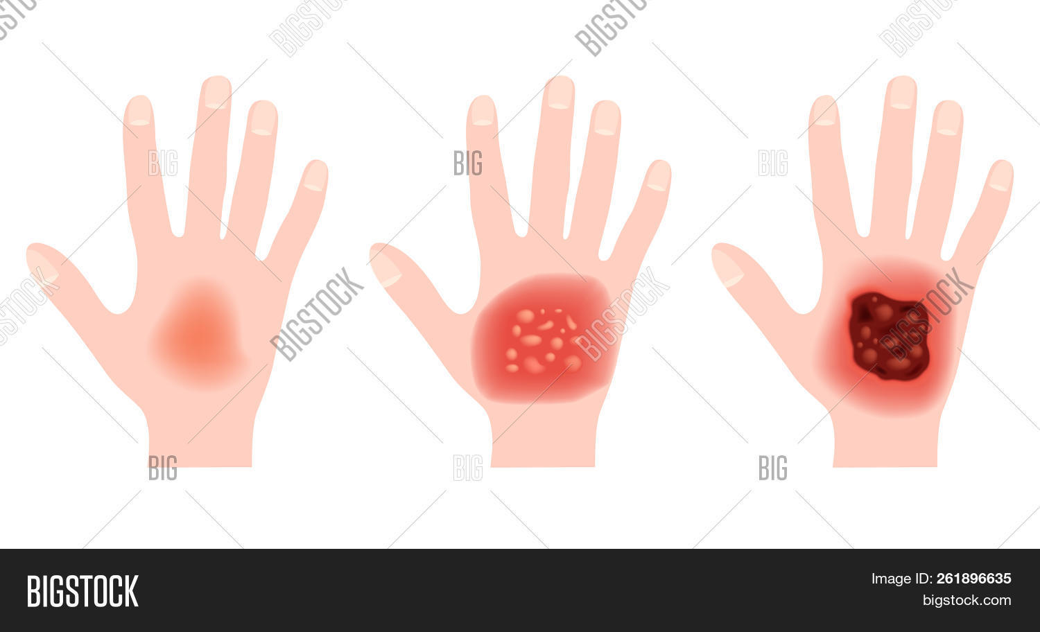 Step Burn . Normal Image & Photo (Free Trial) | Bigstock