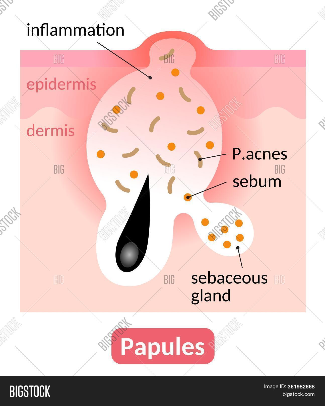 Papules Type Inflamed Image & Photo (Free Trial) | Bigstock