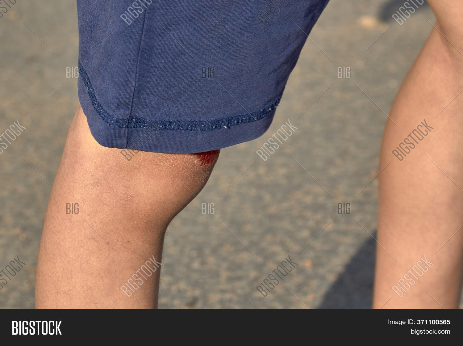 Bruised Wound On Knee Image & Photo (Free Trial) | Bigstock
