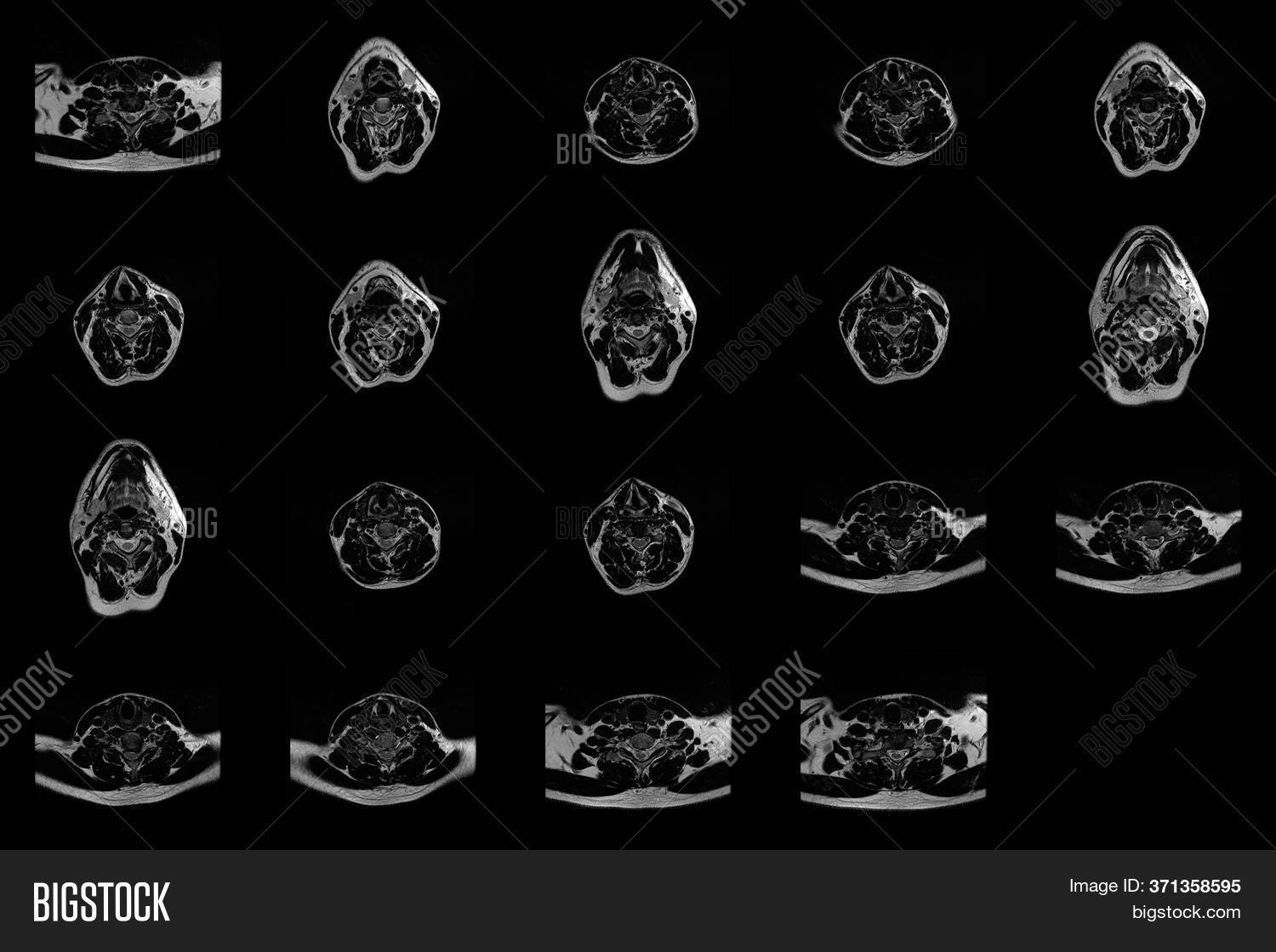 Set Transverse Mri Image & Photo (Free Trial) | Bigstock