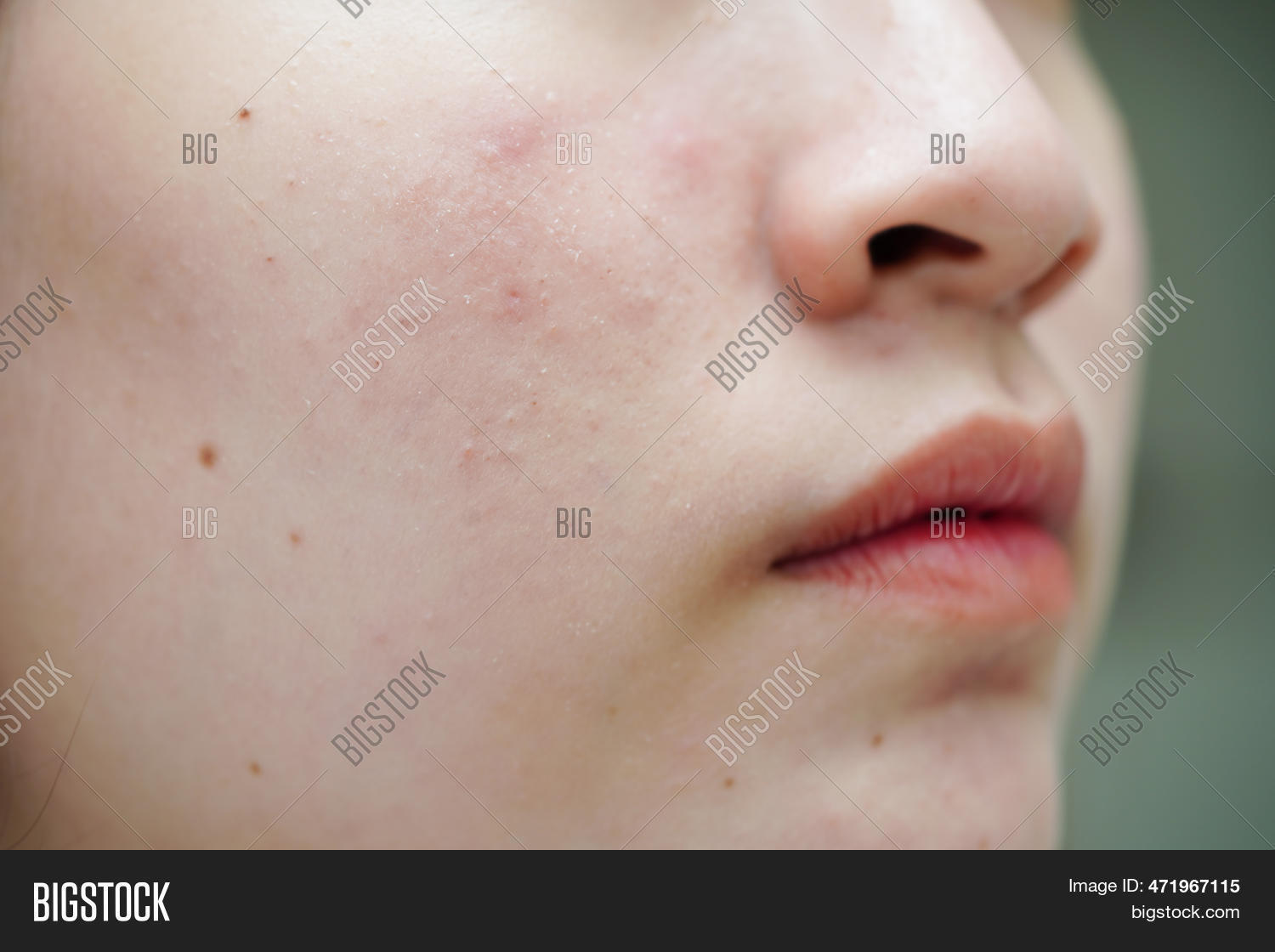 Acne Pimple Scar On Image & Photo (Free Trial) | Bigstock
