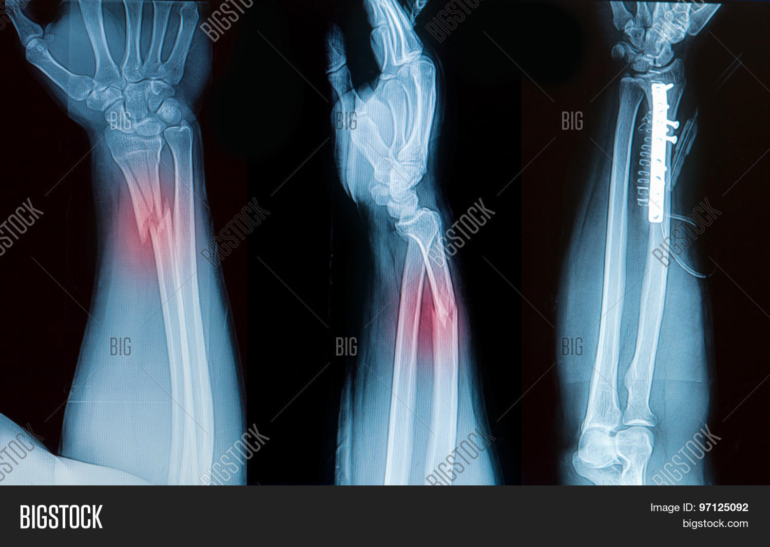X-ray Image Borken Image & Photo (Free Trial) | Bigstock