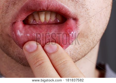 Stomatitis On Lips Man Image & Photo (Free Trial) | Bigstock