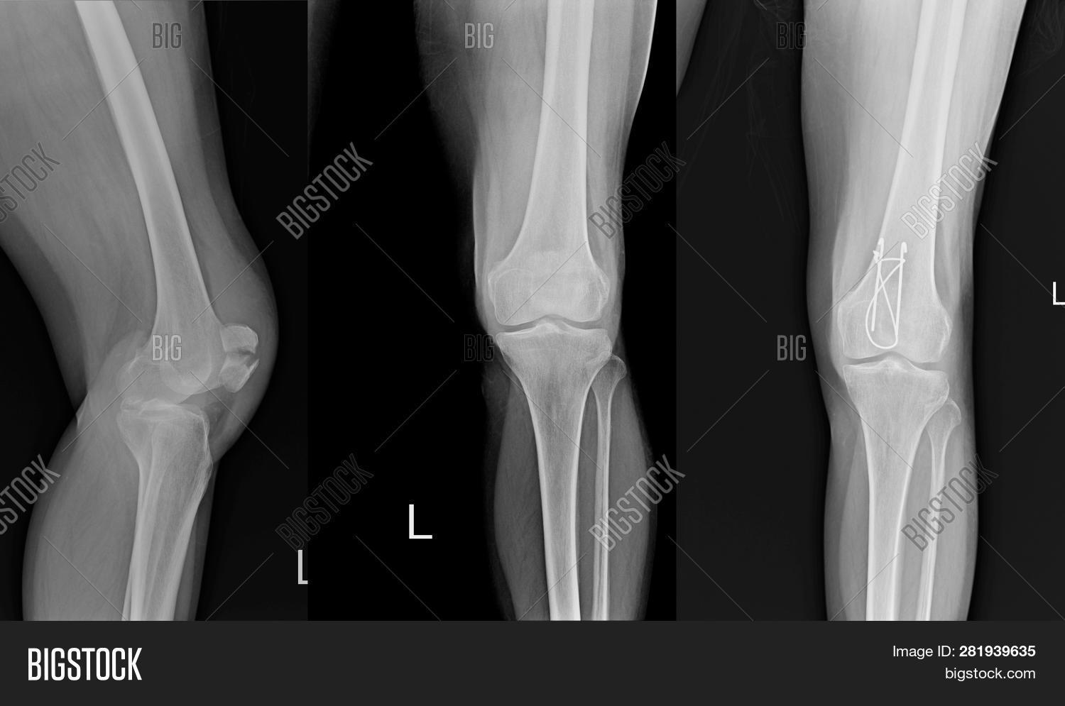 X-ray Left Knee Image & Photo (Free Trial) | Bigstock