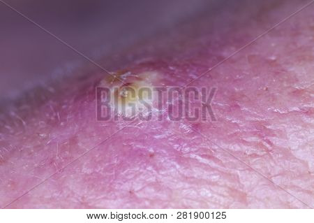Purulent Red Pimple On Image & Photo (Free Trial) | Bigstock
