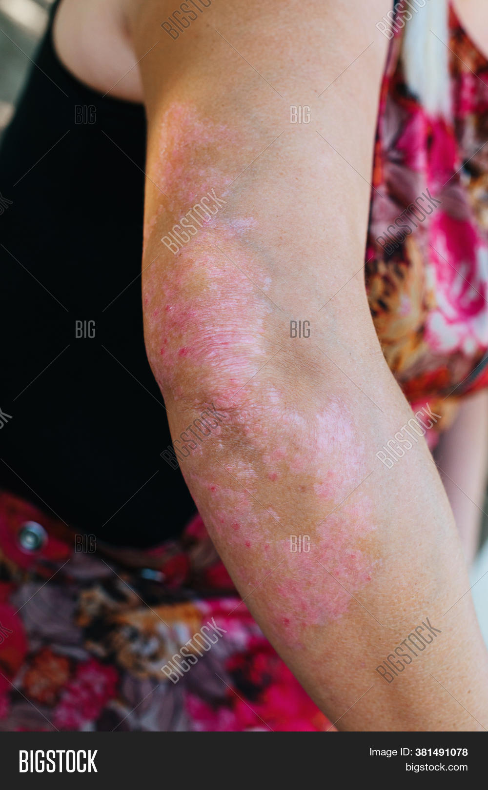 Psoriasis On Elbow Image & Photo (Free Trial) | Bigstock