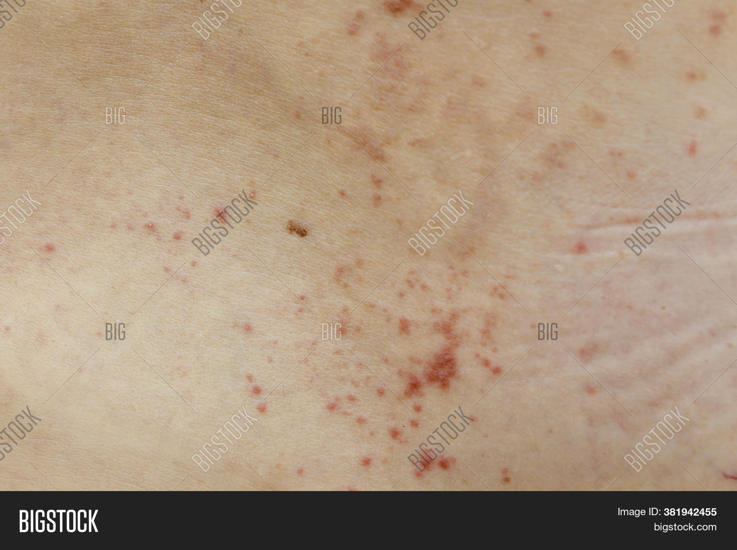 Skin Disease Prickly Image & Photo (Free Trial) | Bigstock
