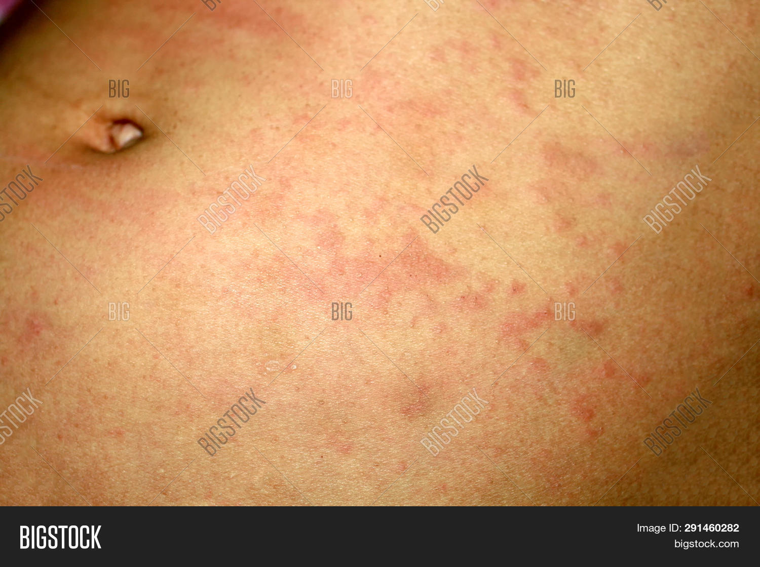 Pink Lichen On Skin Image & Photo (Free Trial) | Bigstock