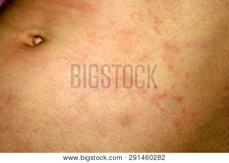 Pink Lichen On Skin Image & Photo (Free Trial) | Bigstock