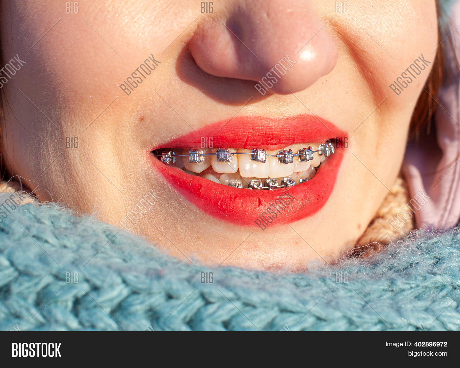 Girl Has Braces On Her Image And Photo Free Trial Bigstock