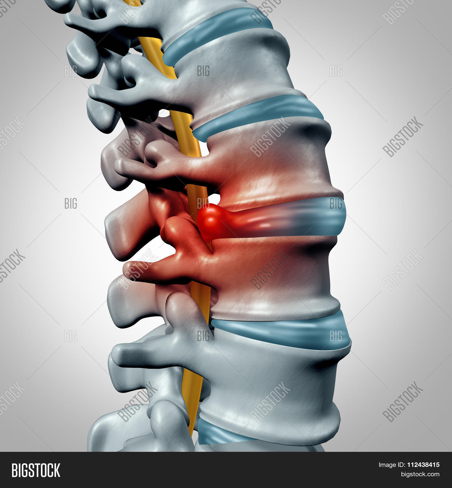 Herniated Disk Image & Photo (Free Trial) | Bigstock