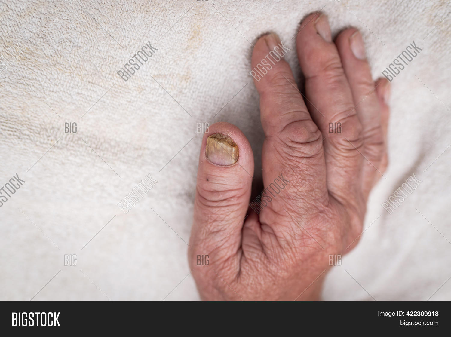 Nail Fungus Infection Image & Photo (Free Trial) | Bigstock