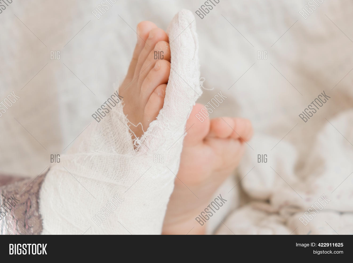 Broken Leg. Close- Image & Photo (Free Trial) | Bigstock