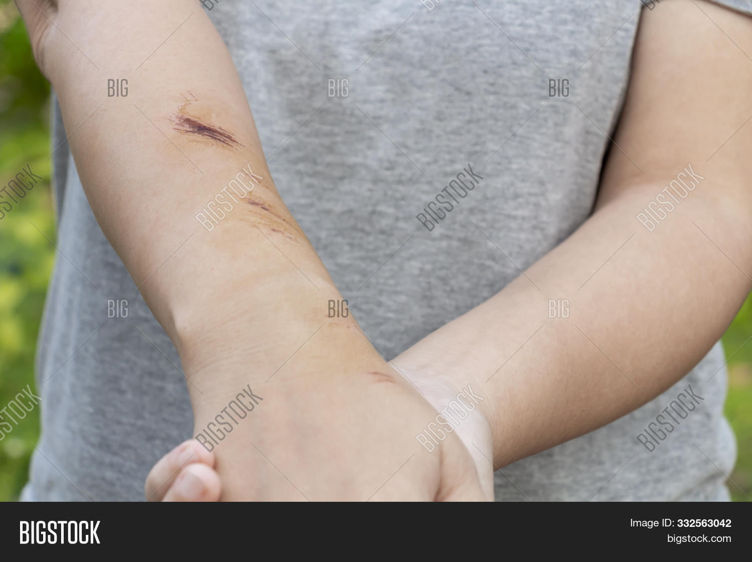 Wound Form Scabs On Image & Photo (Free Trial) | Bigstock