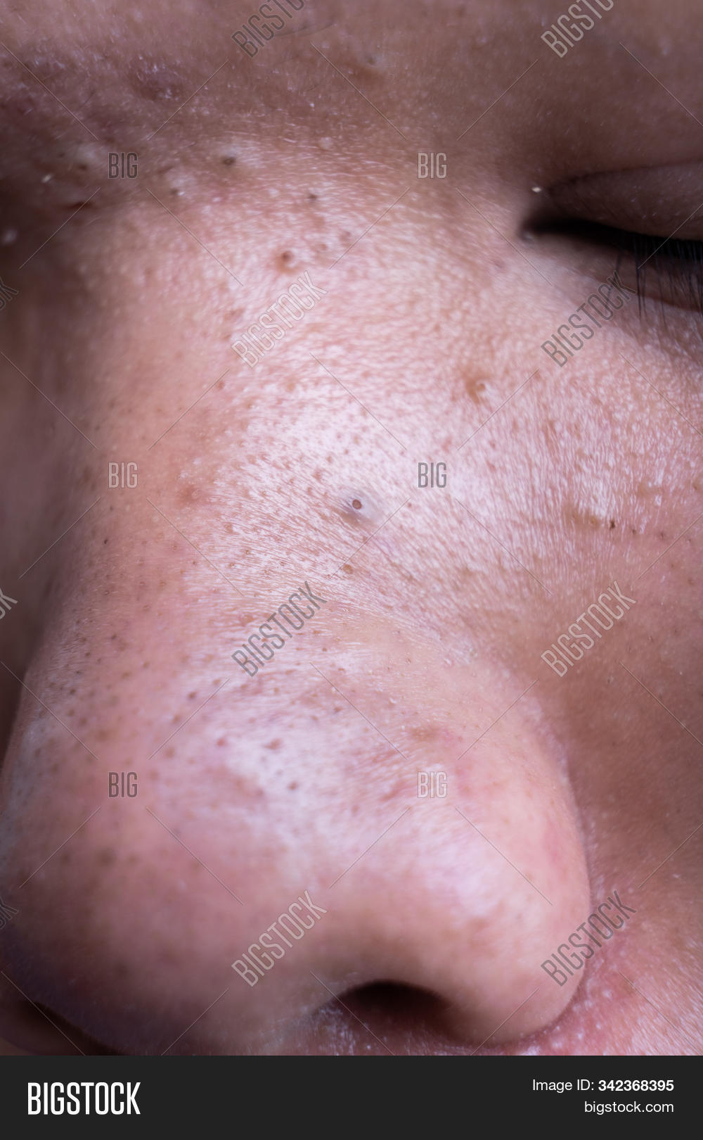 Ugly Pimples Image & Photo (Free Trial) | Bigstock