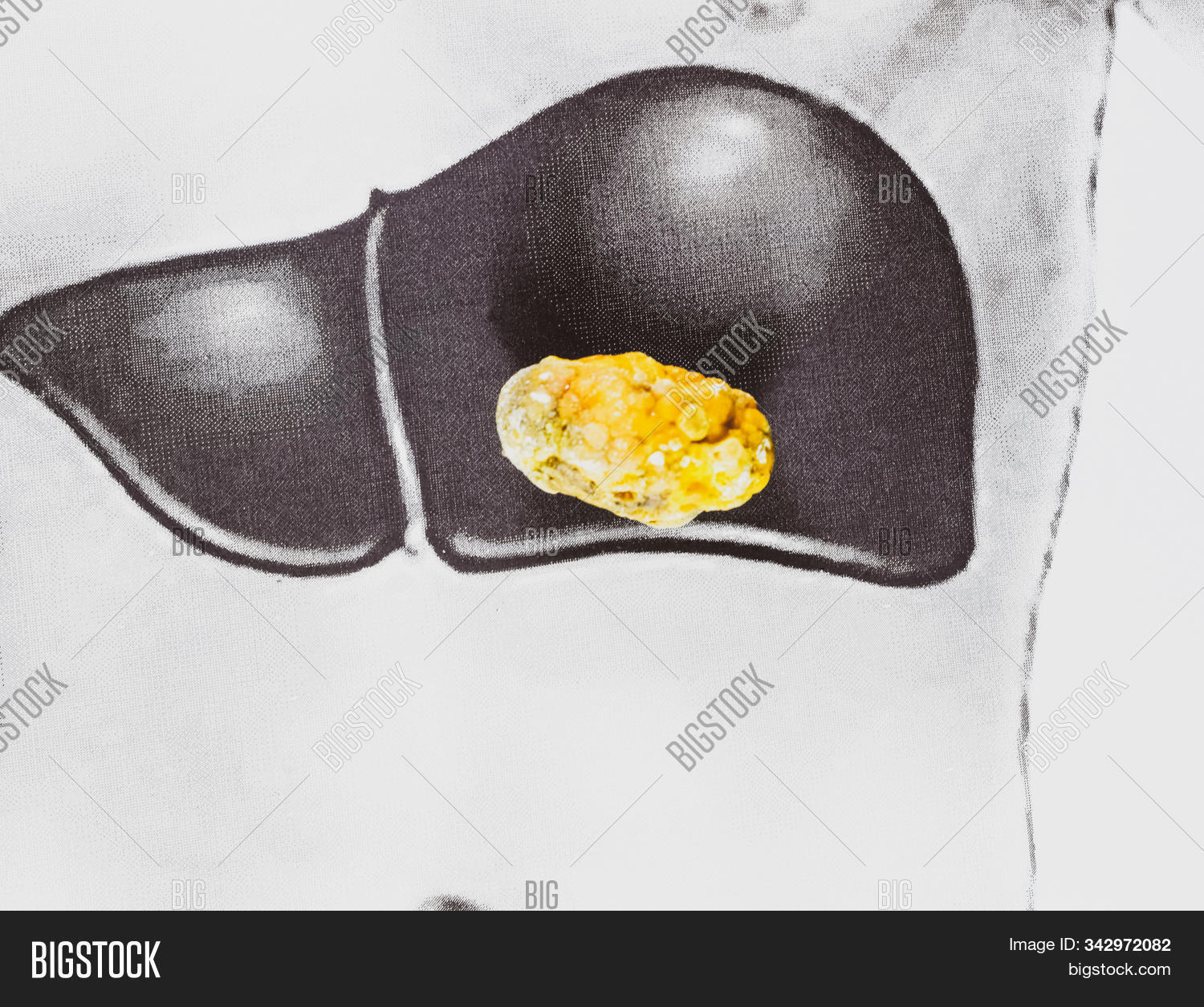 Stone Liver, Schematic Image & Photo (Free Trial) | Bigstock