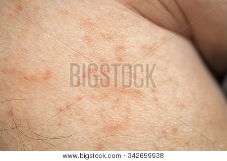 Skin Disease Winter. Image & Photo (Free Trial) | Bigstock
