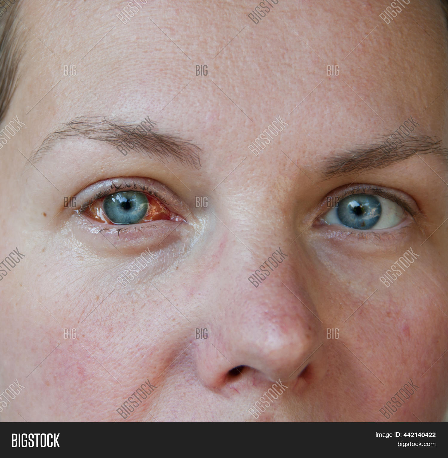 Woman's Right Eye Sick Image & Photo (Free Trial) | Bigstock