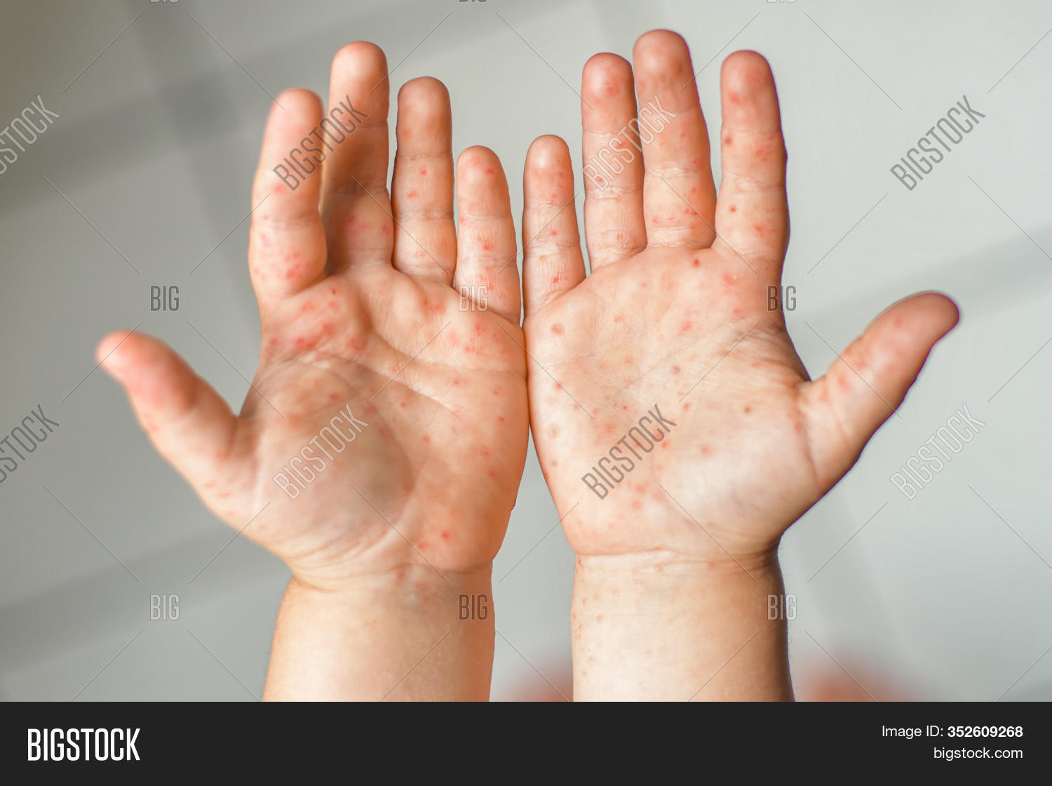 Enterovirus Leg Arm Image & Photo (Free Trial) | Bigstock