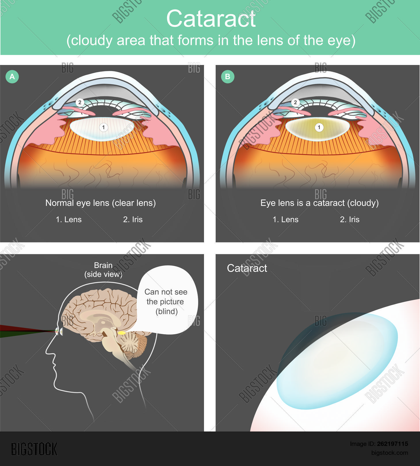 Cataract Dense Cloudy Vector & Photo (Free Trial) | Bigstock
