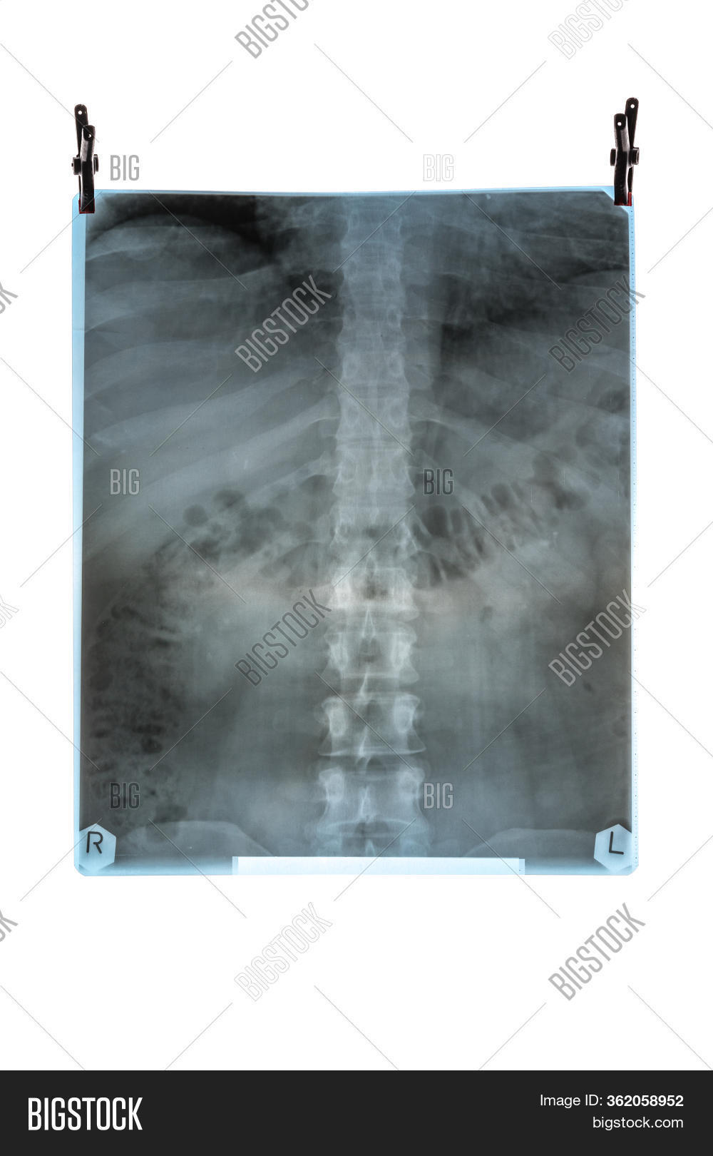 X-ray Image Spine Ribs Image & Photo (Free Trial) | Bigstock