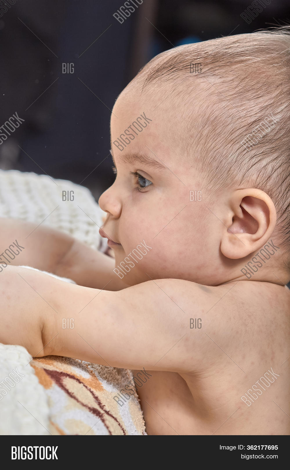 Roseola Rash Viral Image & Photo (Free Trial) | Bigstock