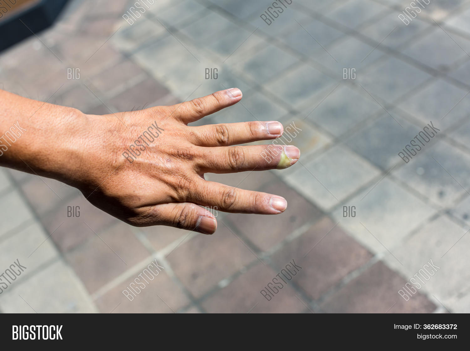 Paronychia, Swollen Image & Photo (Free Trial) | Bigstock