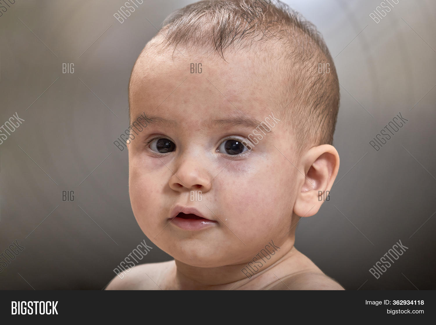Roseola Rash Viral Image & Photo (Free Trial) | Bigstock