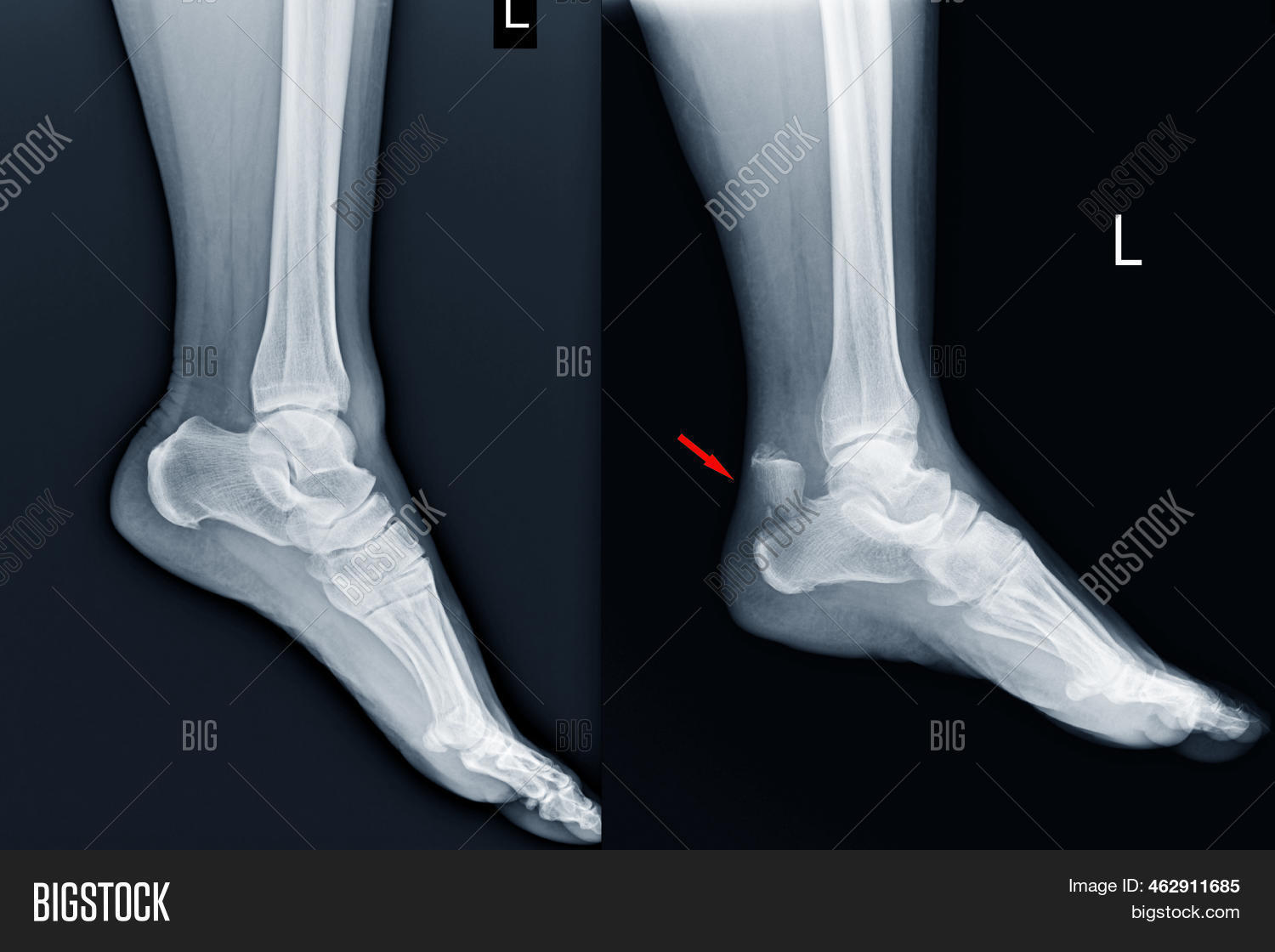 Film Ankle X-ray Image & Photo (Free Trial) | Bigstock