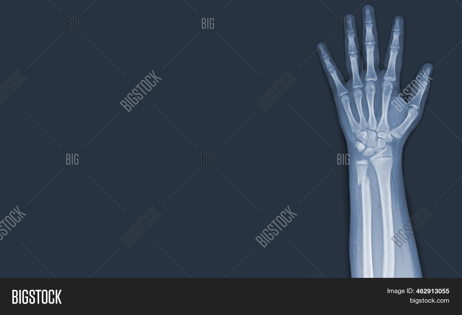 X-ray Images Hand Image & Photo (Free Trial) | Bigstock